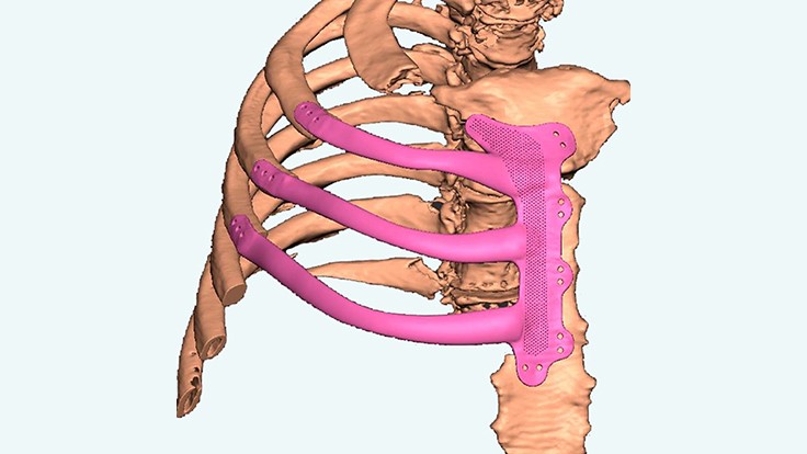 Metal additive manufactured rib prosthesis implanted - Today's Medical ...