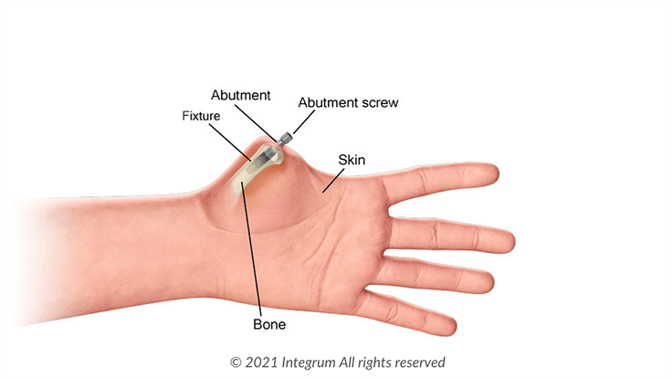 Thumb replacement with a bone-anchored system - Today's Medical ...