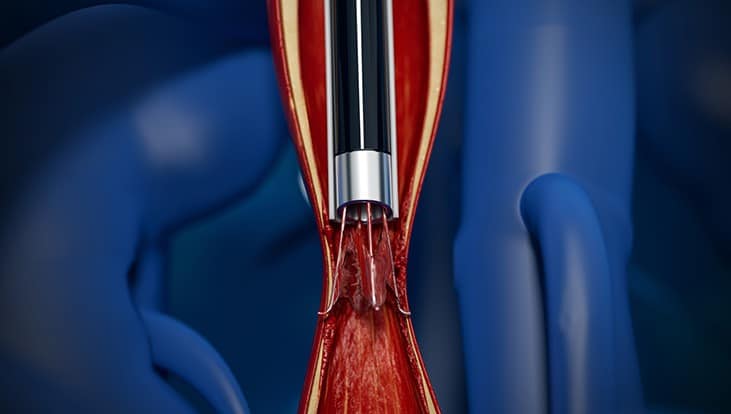 Philips receives clearance for CavaClear - Today's Medical Developments