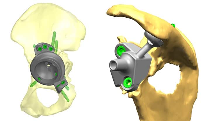3DP patient-specific implant successes - Today's Medical Developments