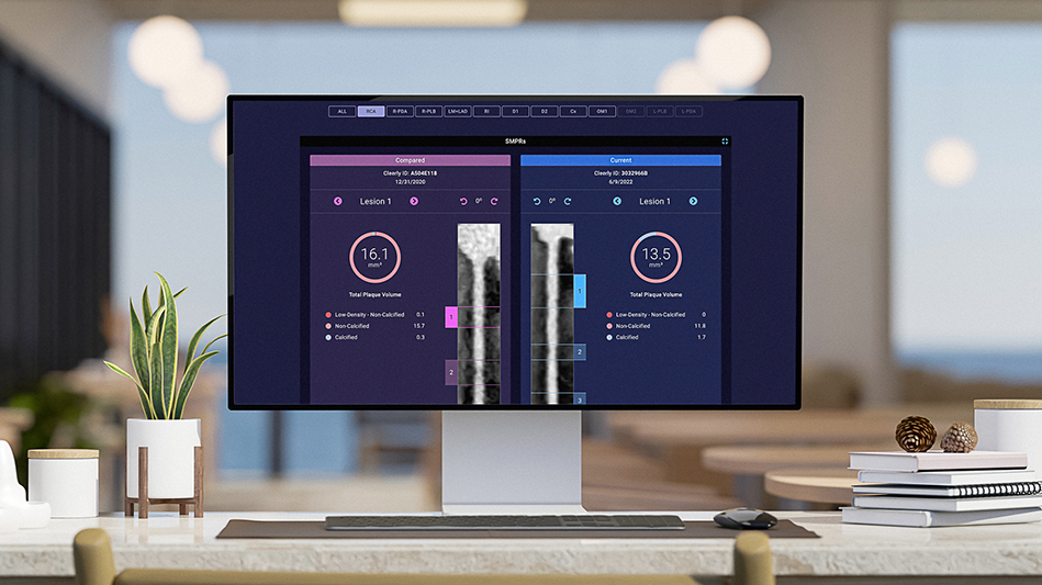 A personalized care pathway for heart attack prevention - Today's ...