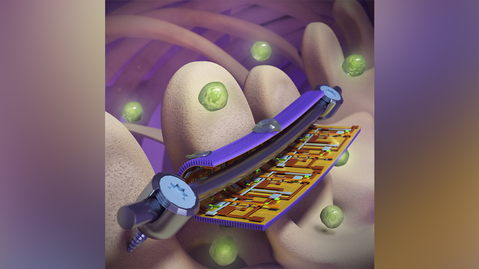 Smart coatings for surgical orthopedic implants - Today's Medical ...