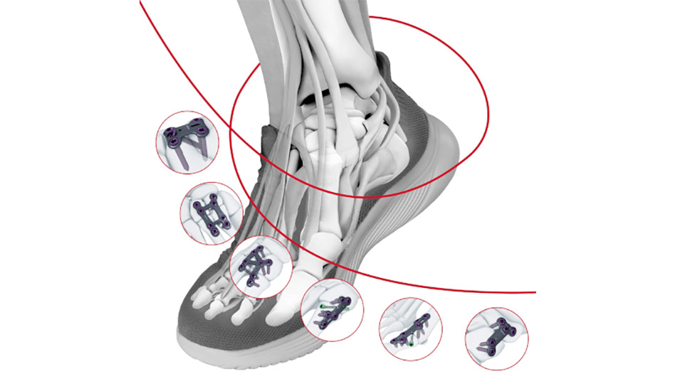 DePuy Synthes receives FDA clearance for TriLEAP - Today's Medical ...