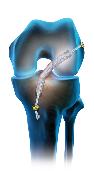Arthrex releases all-suture implant for ACL reconstruction - Today's ...