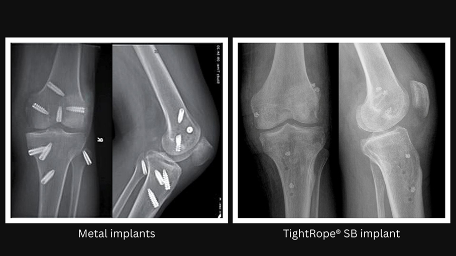 Arthrex releases all-suture implant for ACL reconstruction - Today's ...