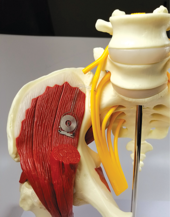 Implant, electrical stimulation speeds nerve regeneration - Today's ...