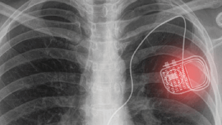 Blasting light through human flesh to power implants - Today's Medical ...